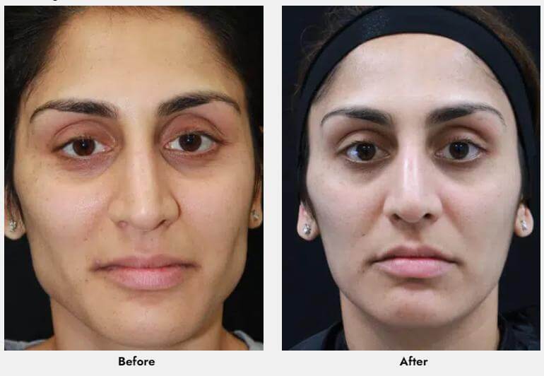 Botox for Cheek Lift: Before and After