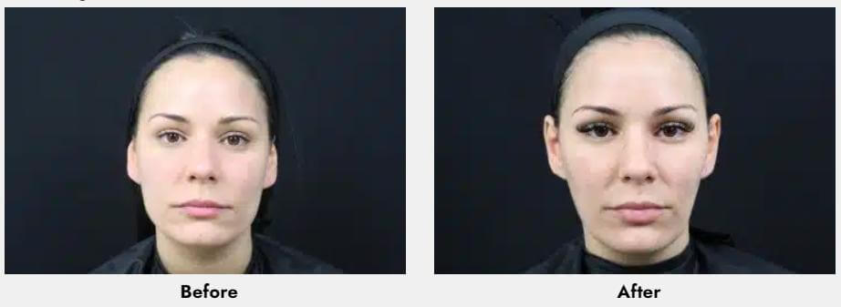 Botox for Cheek Lift: Before and After